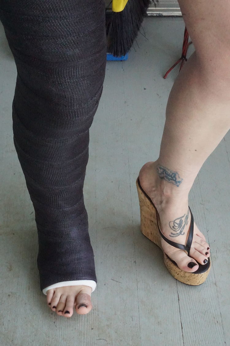 Hard Wrapped + Casts + Orthodontics + Crutches | cnews