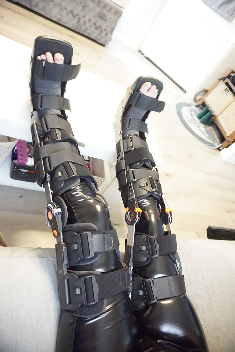 Hard Wrapped + Casts + Orthodontics + Crutches | cnews