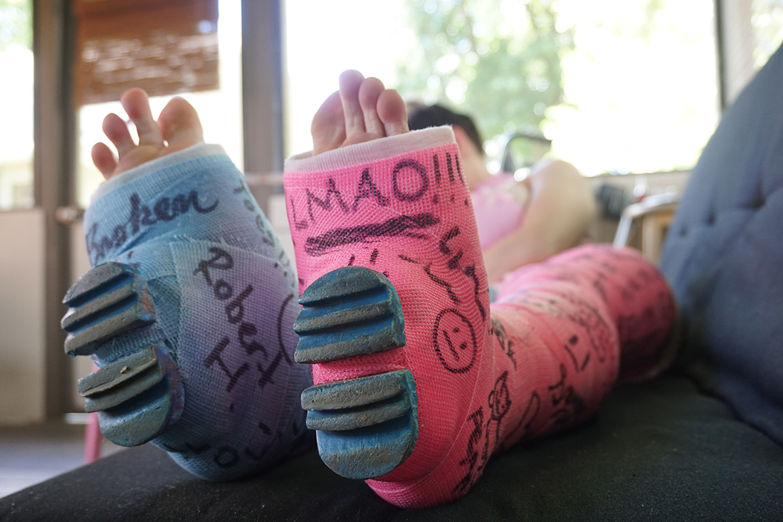 Hard Wrapped + Casts + Orthodontics + Crutches | cnews